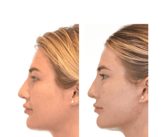 Blogs: Face-Lift | Dallas Surgical Arts