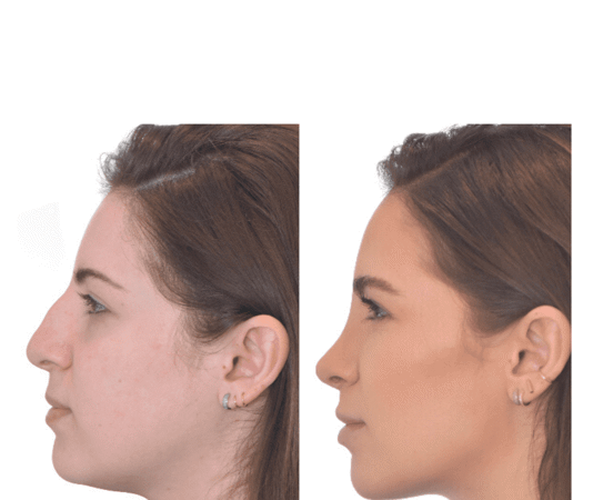 Blogs: Rhinoplasty | Dallas Surgical Arts