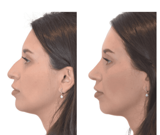 Blogs: Rhinoplasty | Dallas Surgical Arts