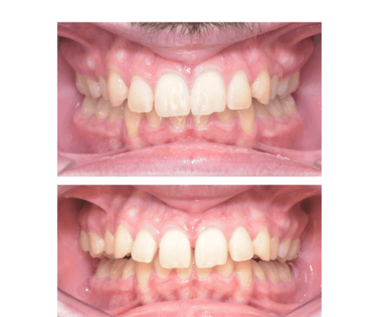 Blogs: Jaw Surgery | Dallas Surgical Arts
