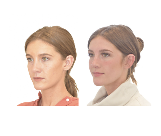 Blogs: Genioplasty | Dallas Surgical Arts