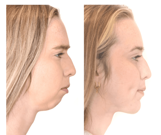 Blogs: Genioplasty | Dallas Surgical Arts