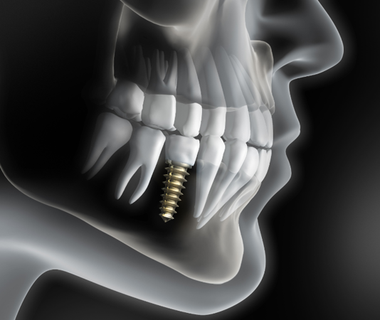 Blogs: Oral Surgery | Dallas Surgical Arts