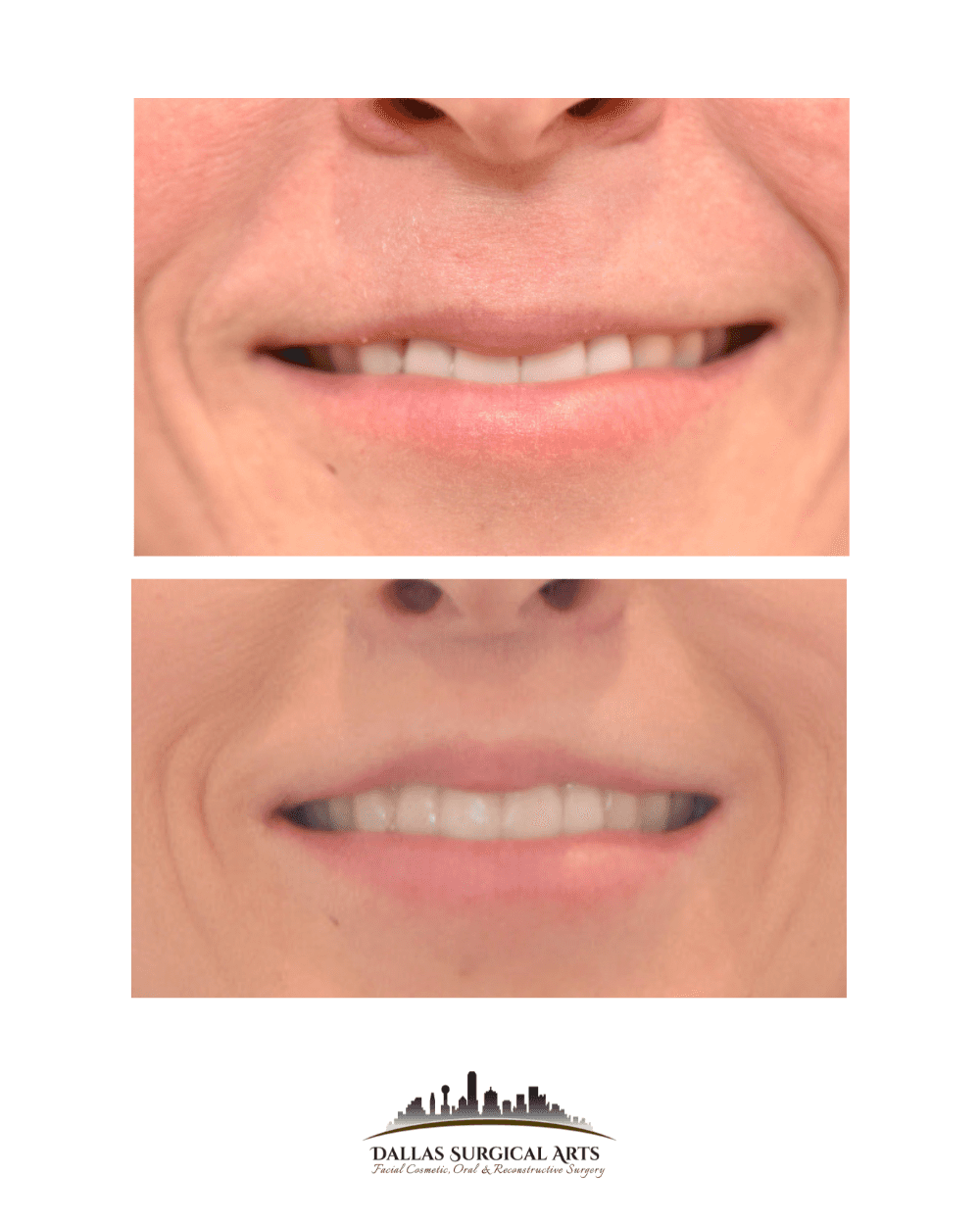 Lip Lift | Oral Surgery in Dallas
