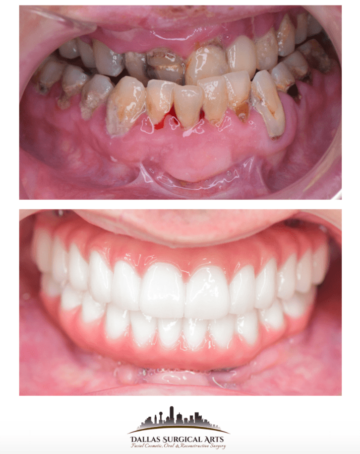 The Solution to Missing Teeth: All on Four Dental Implants in Dallas