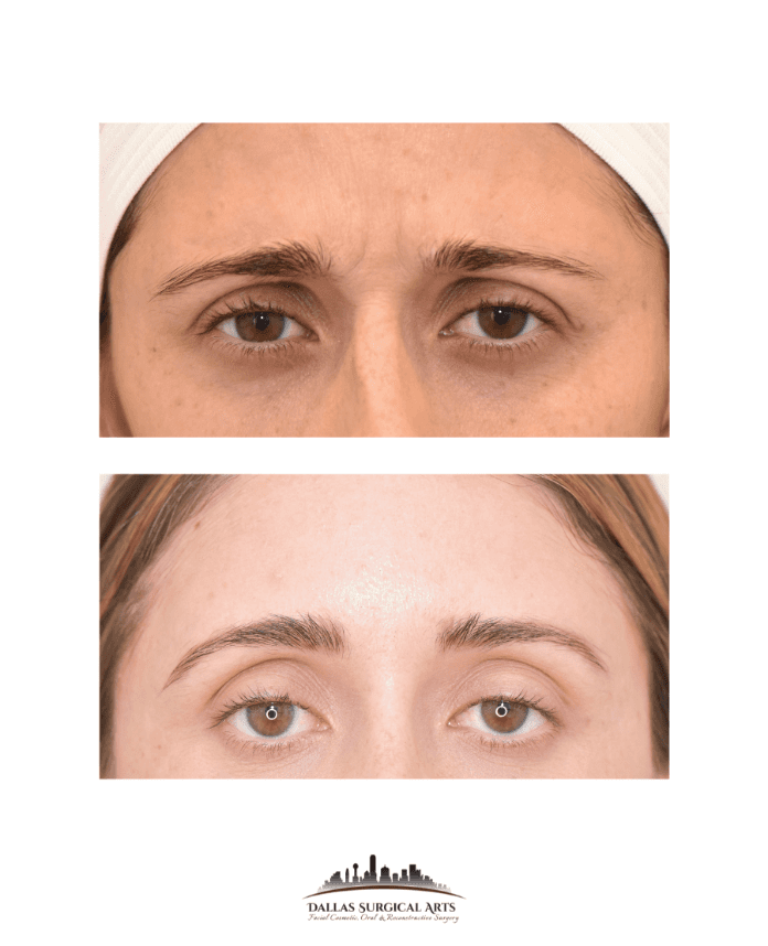 Enhance Your Appearance with the Dallas Endoscopic Brow Lift at Dallas ...