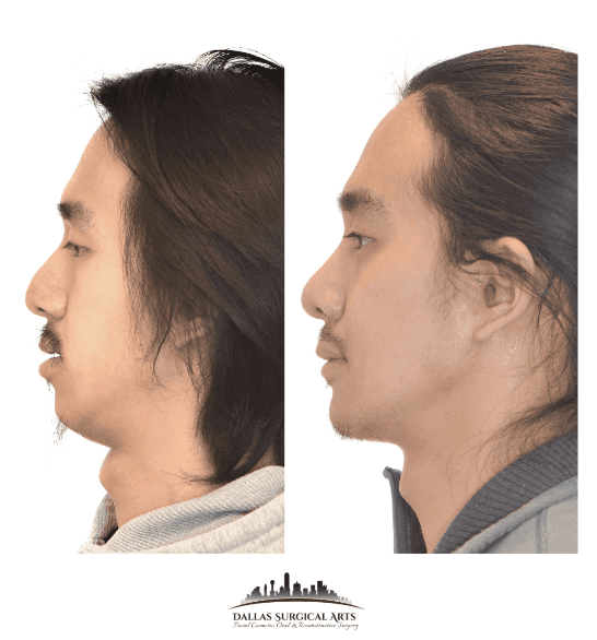 Popular Procedures with Dallas Maxillofacial Surgeon Dr. Randy Sanovich