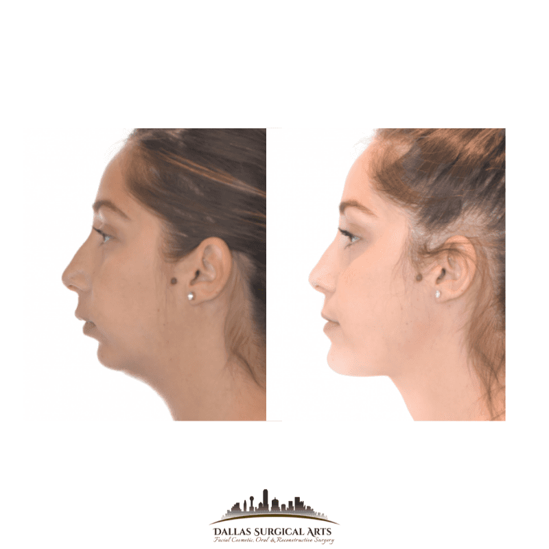 Jaw Surgery in Dallas: Oral and Maxillofacial Surgery in 2023 at Dallas ...