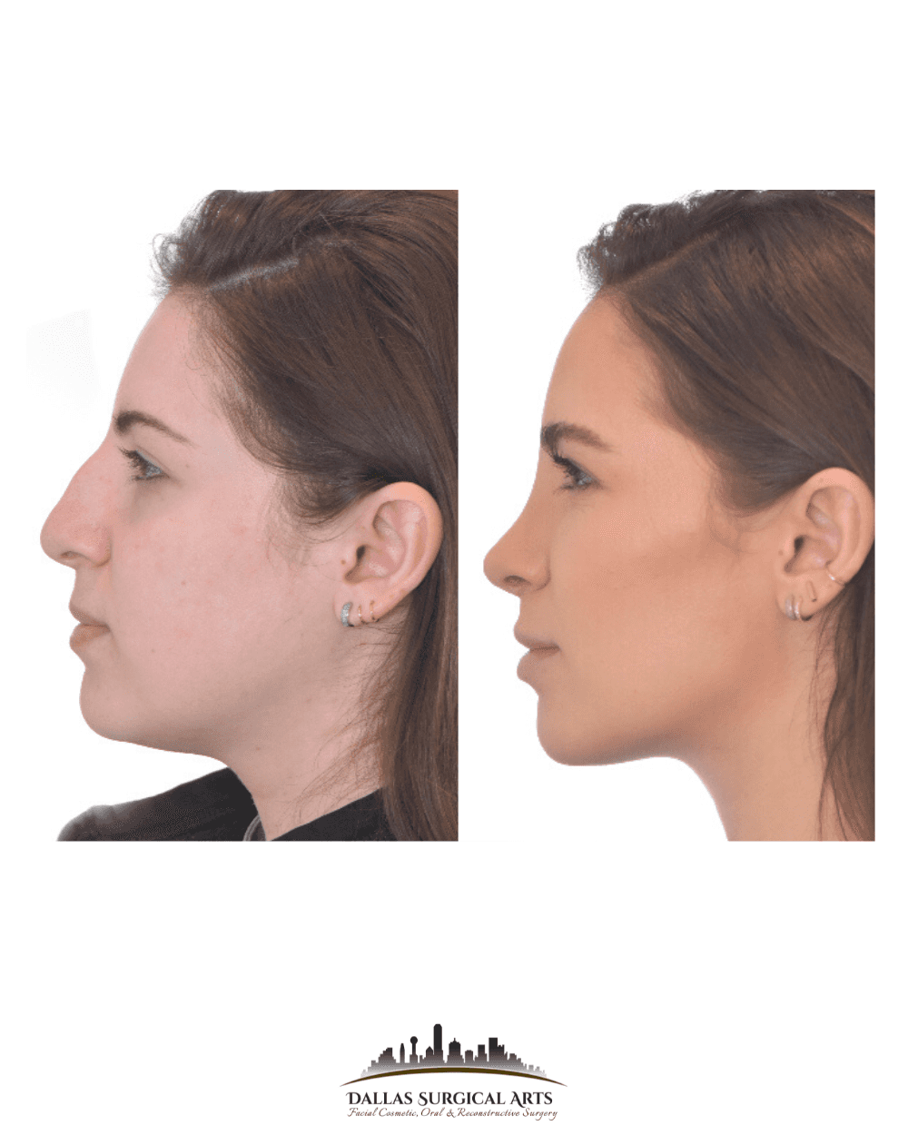 Enhance Your Nose Shape with Rhinoplasty: Understanding Different Types ...