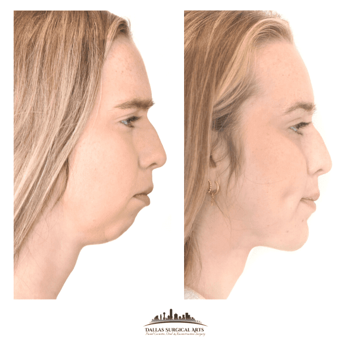 Enhance Your Facial Profile with Dallas Chin Augmentation: Achieve a ...