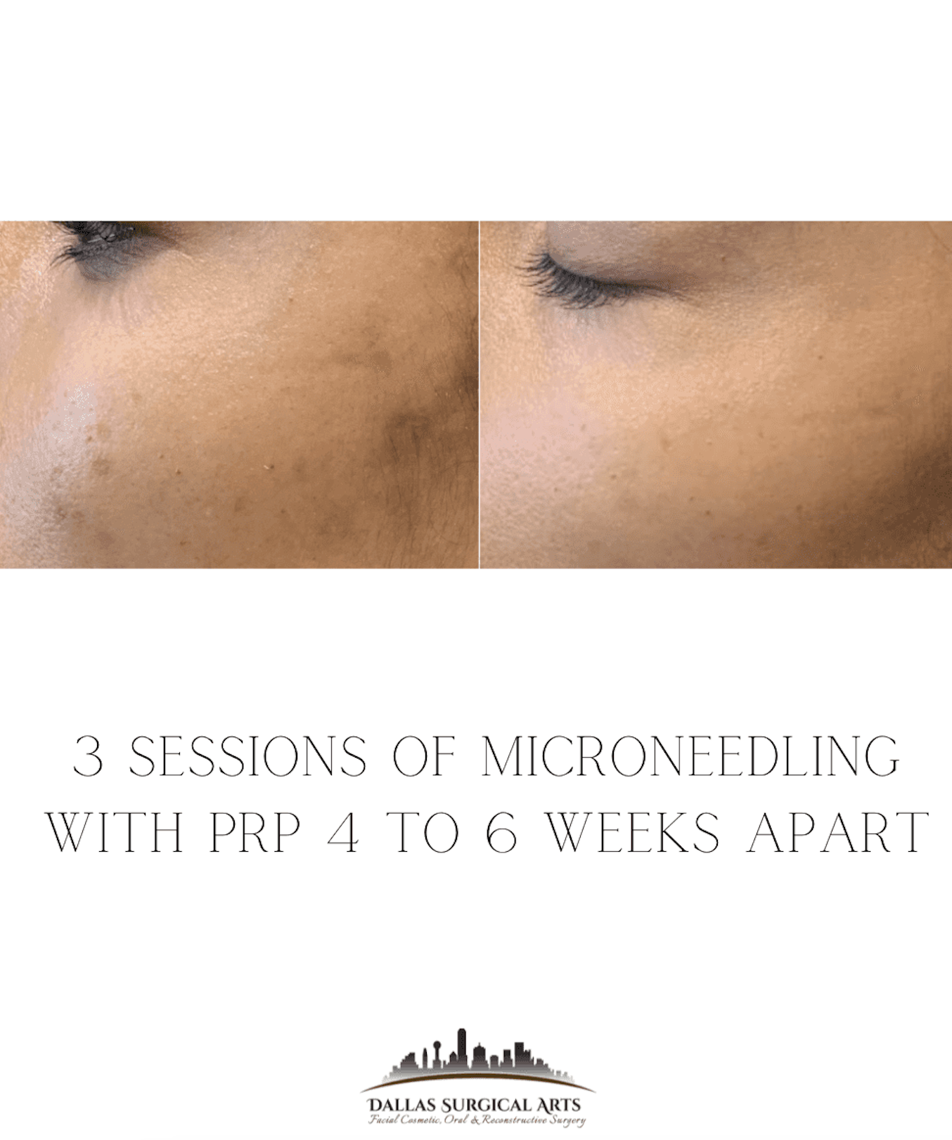 The Benefits of Microneedling: Rejuvenate Your Skin at Dallas Surgical Arts