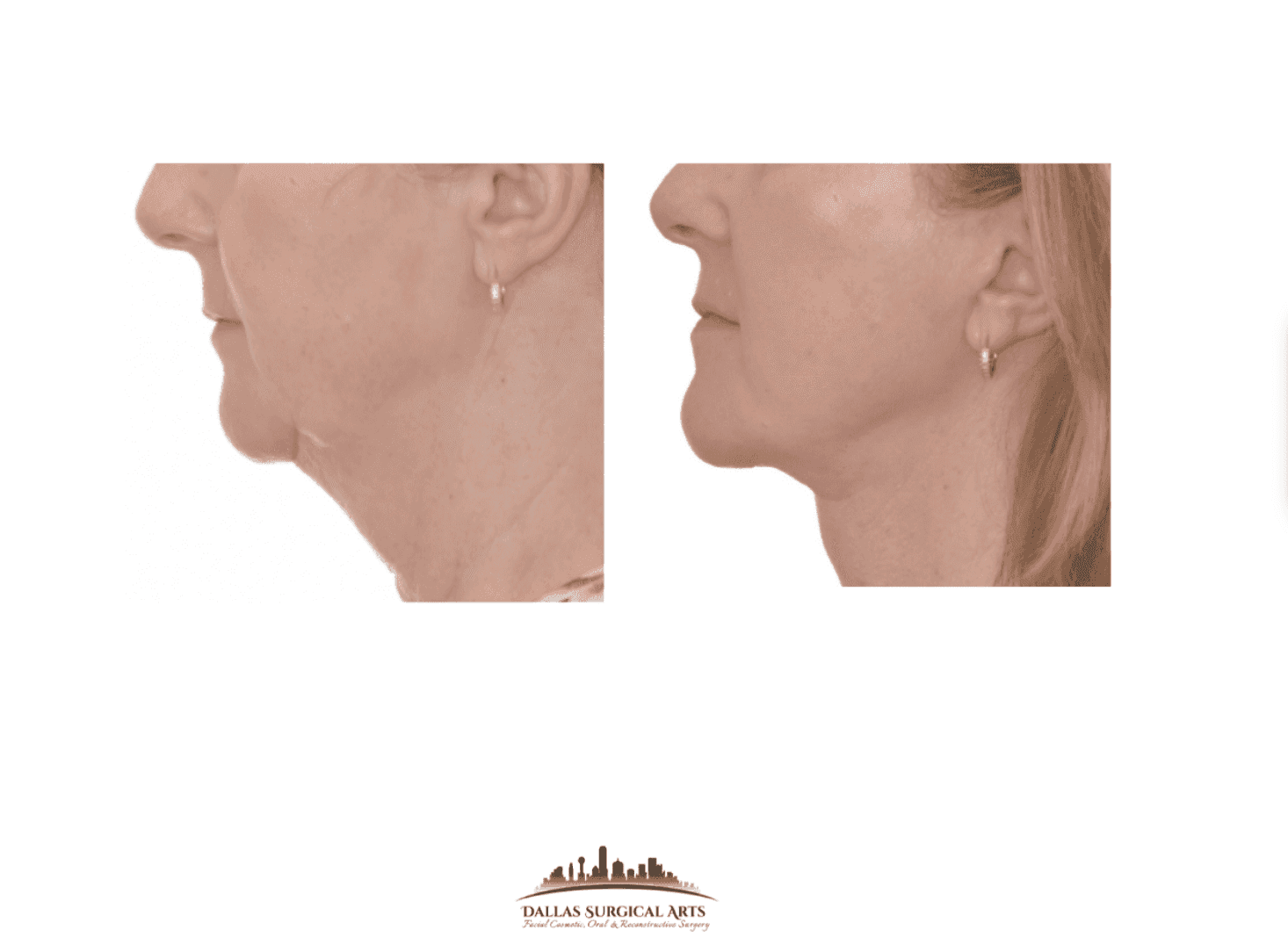 Facial Cosmetic Surgery in Dallas with Dr. Randy Sanovich at Dallas ...