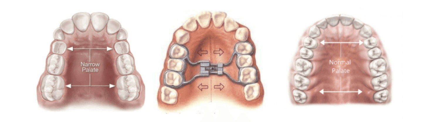 Palatal Expansion Surgery: Understanding the Procedure and FAQs