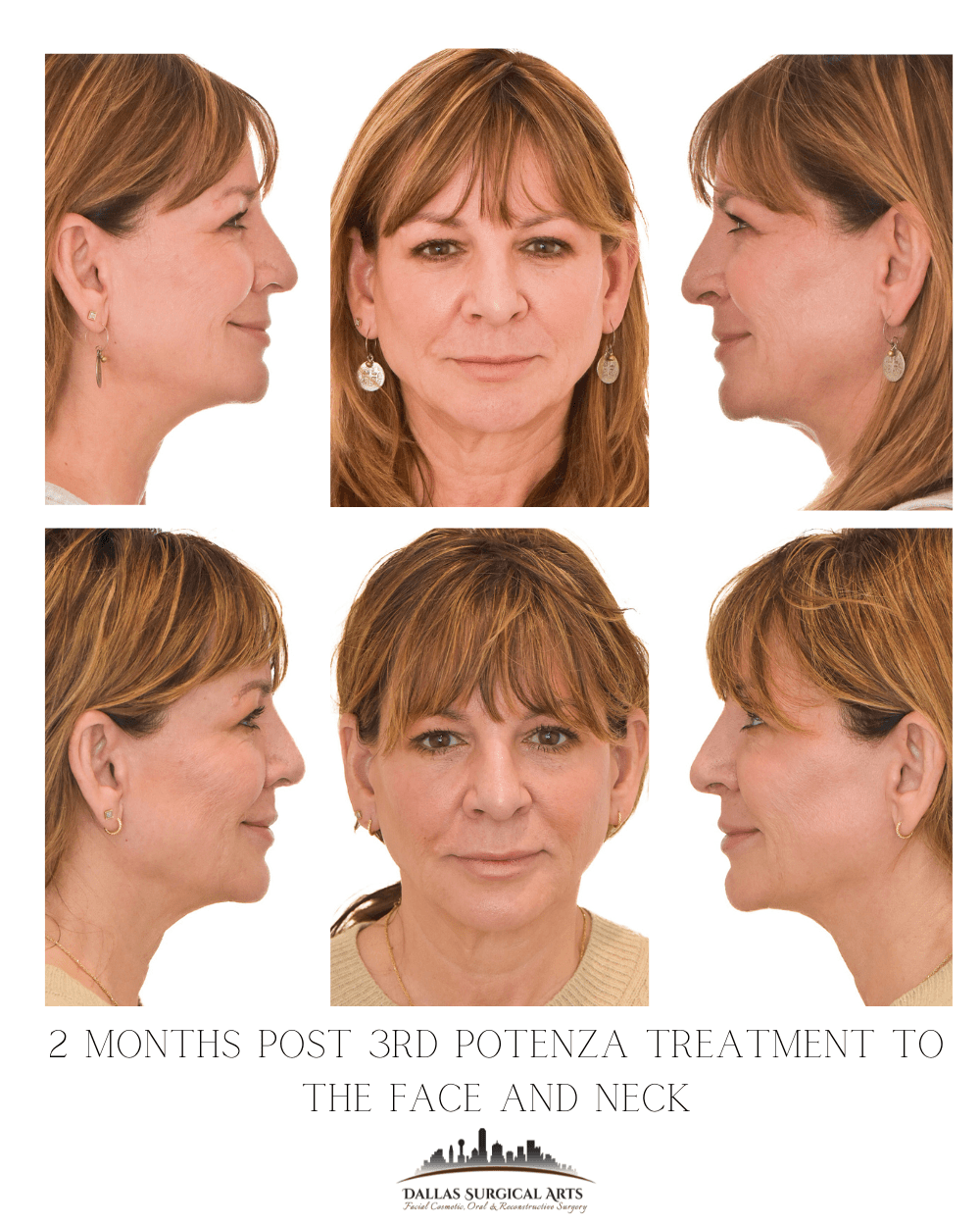 Potenza RF Microneedling | Dallas Surgical Arts