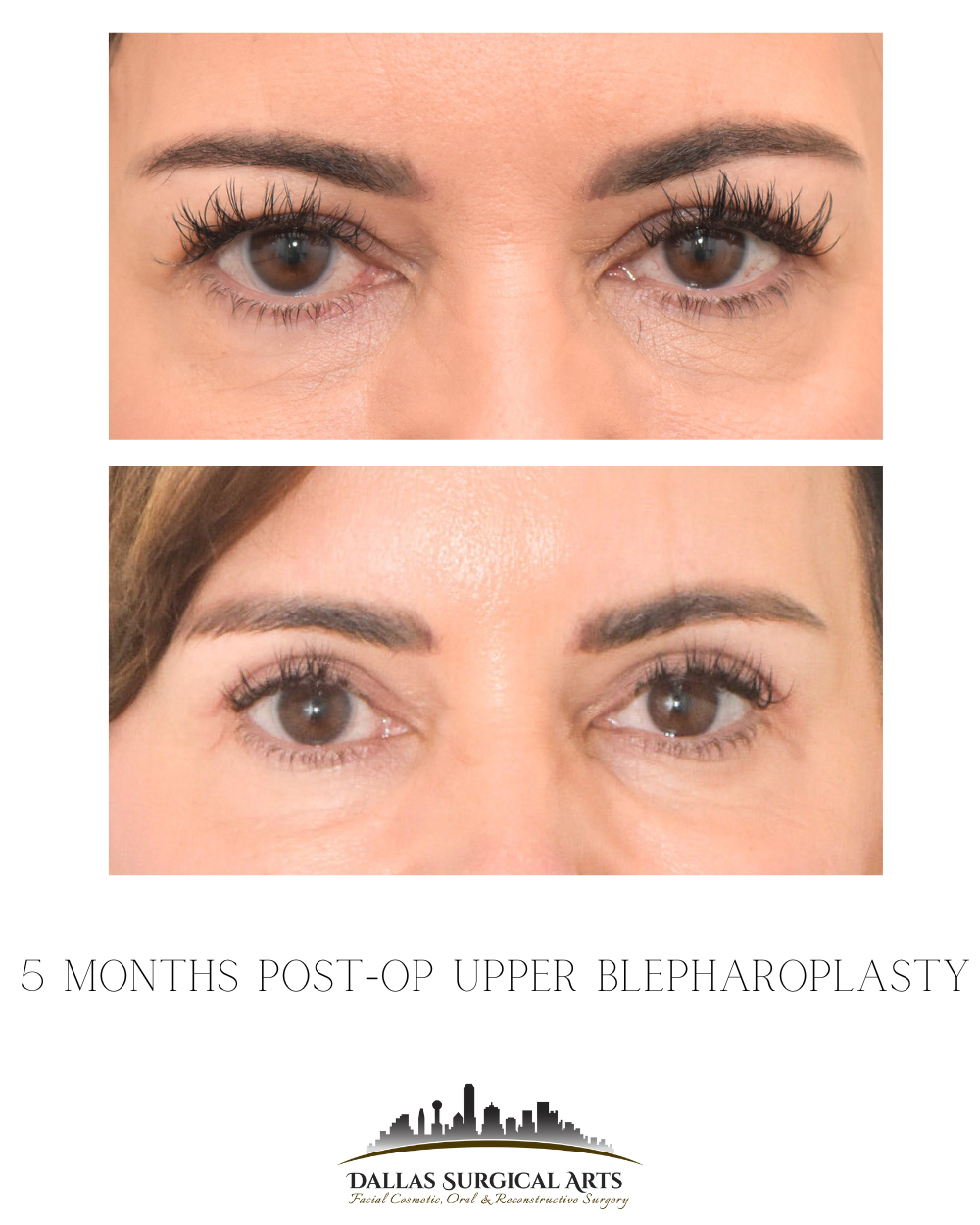 Blepharoplasty | Dallas Oral Surgery