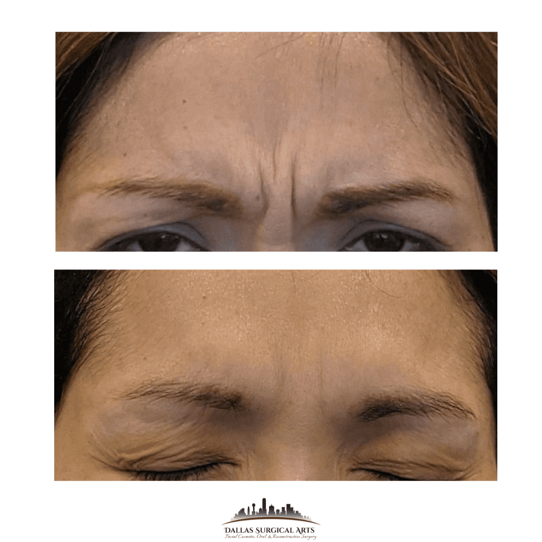 Botox | Dallas Oral Surgery