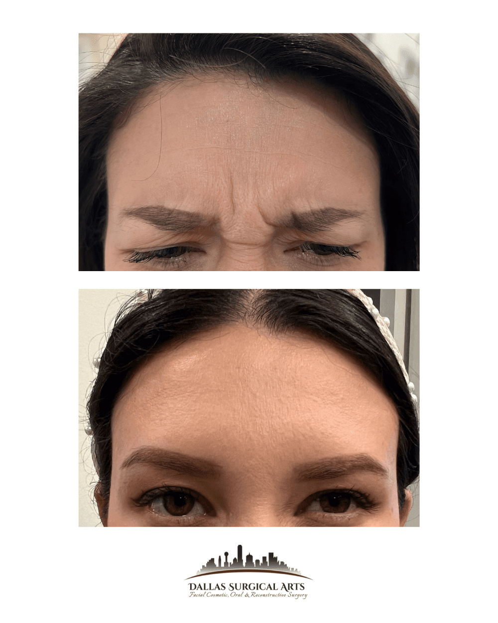 Botox | Dallas Oral Surgery