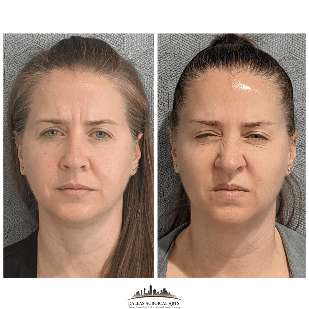Botox | Dallas Oral Surgery