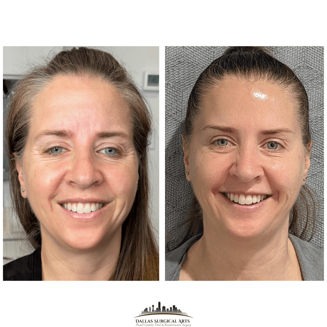 Botox | Dallas Oral Surgery