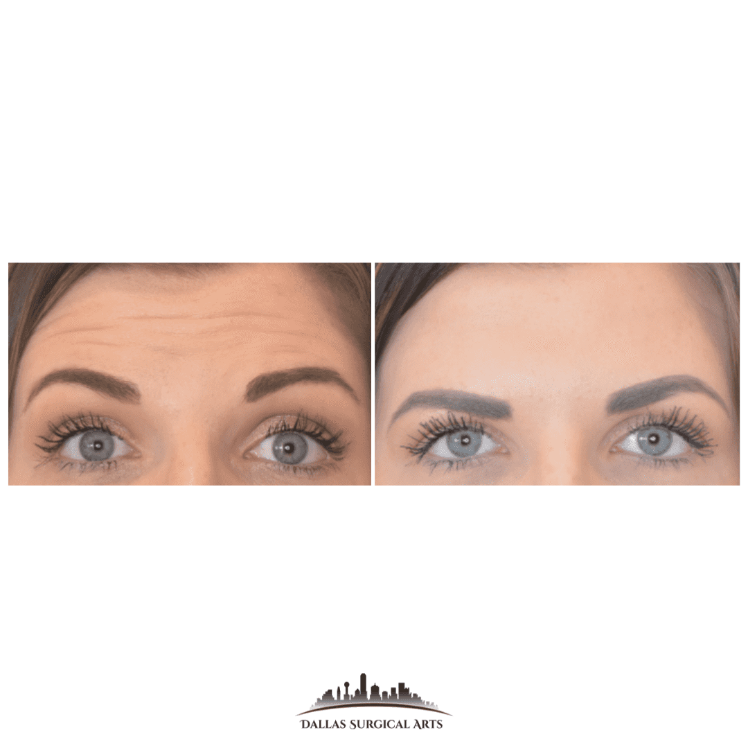 Botox | Dallas Oral Surgery