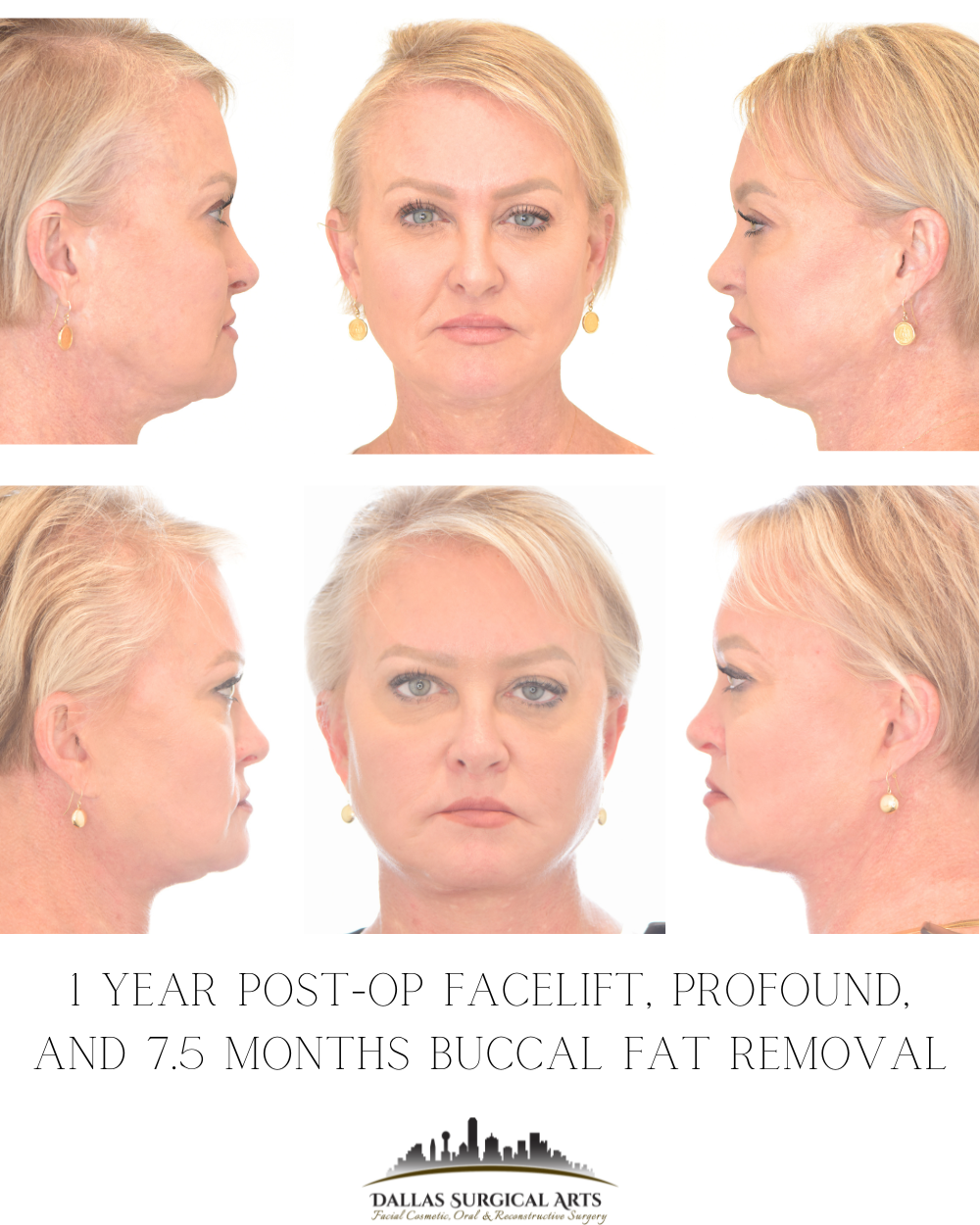 Buccal Fat Removal | Dallas Oral Surgery
