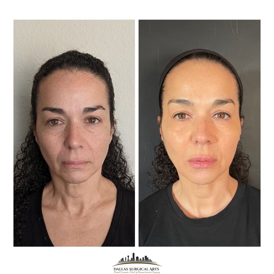 Cheek Filler | Dallas Oral Surgery