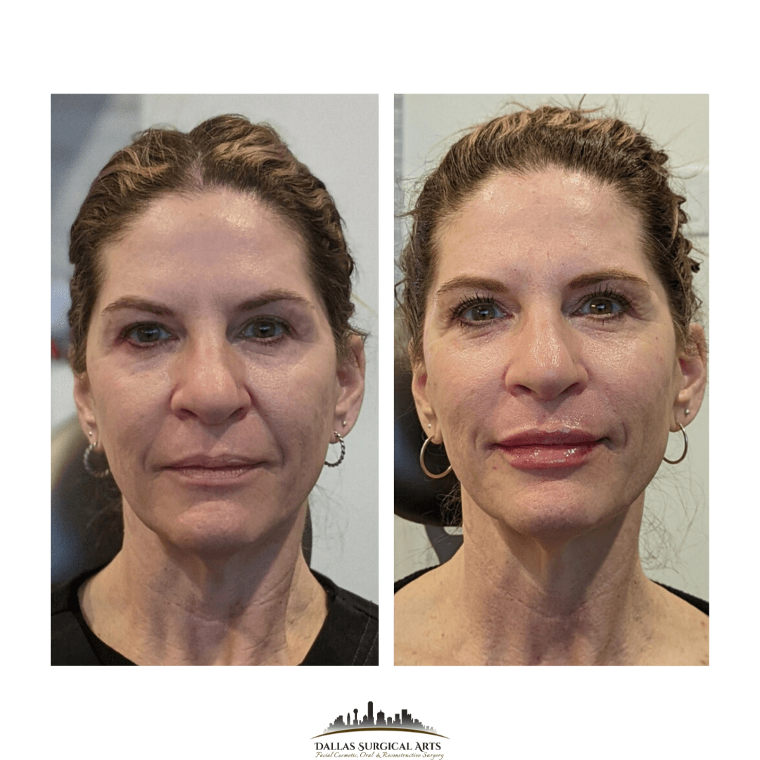 Cheek Filler | Dallas Oral Surgery
