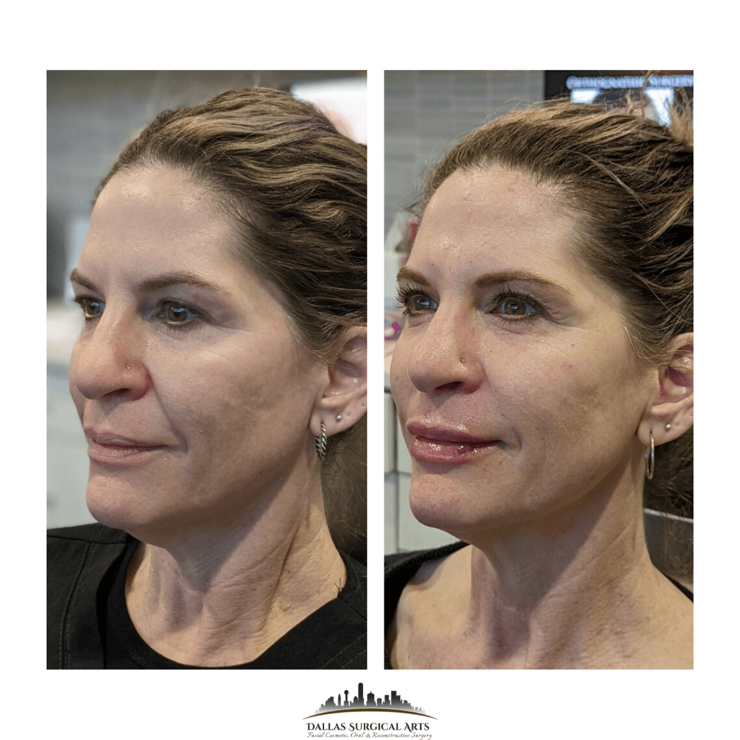 Cheek Filler | Dallas Oral Surgery