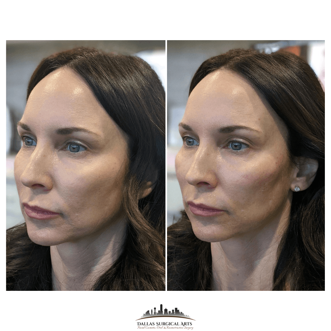 Cheek Filler | Dallas Oral Surgery