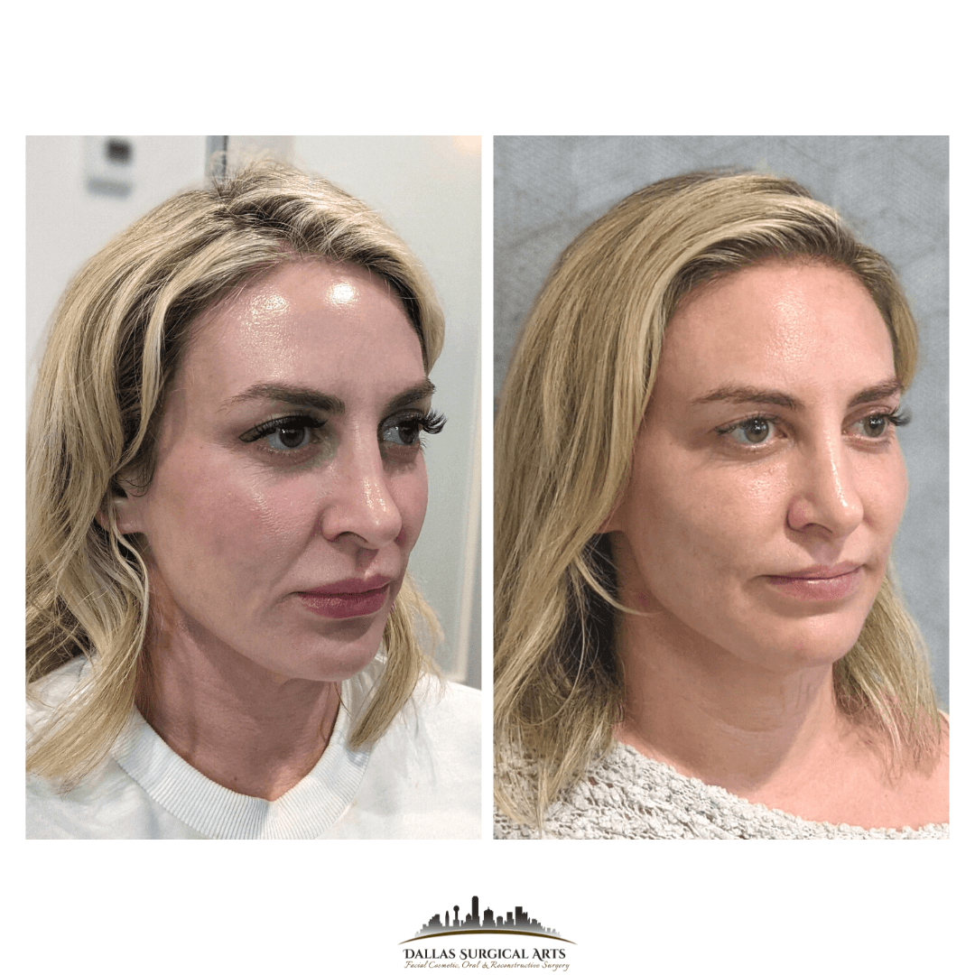 Cheek Filler | Dallas Oral Surgery
