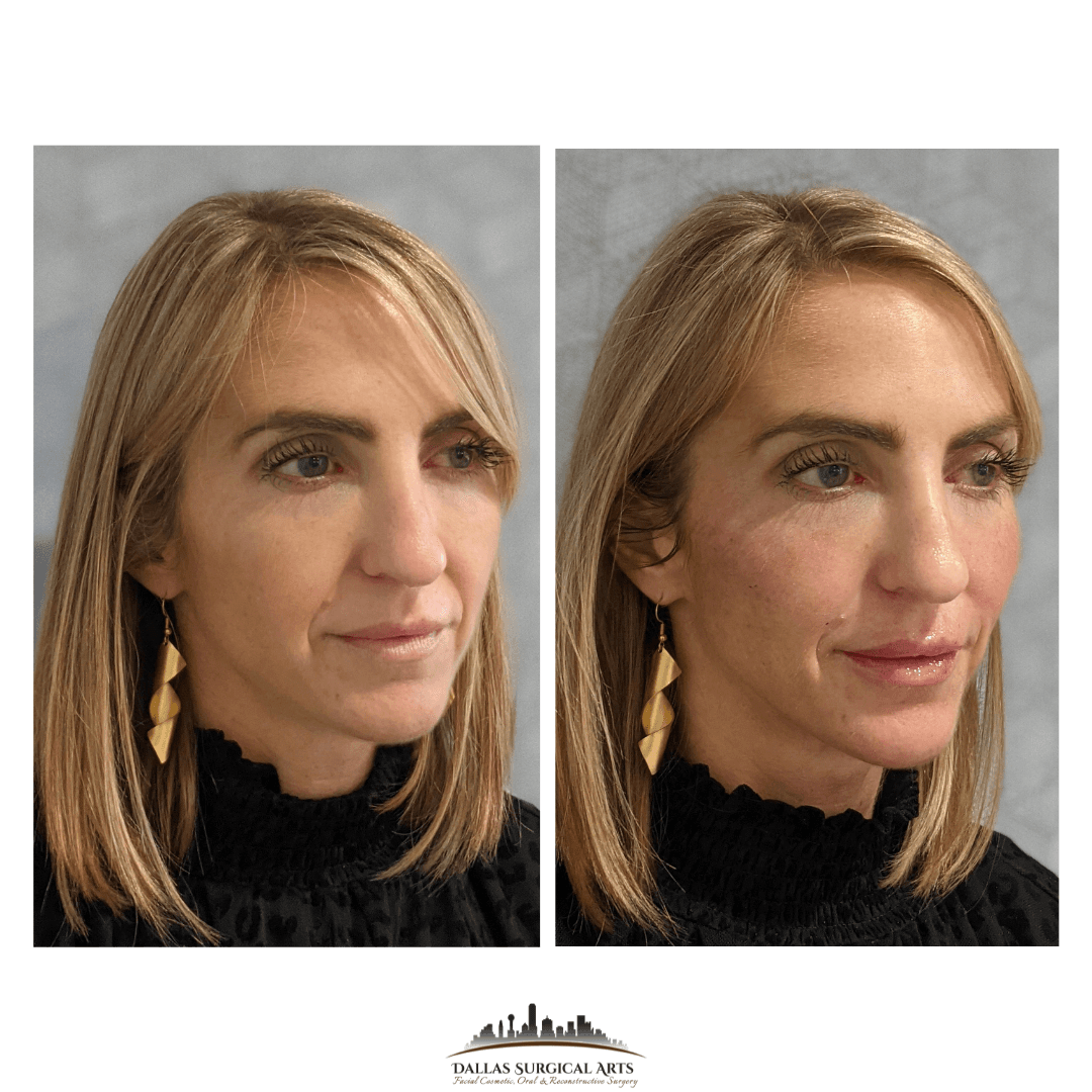Cheek Filler | Dallas Oral Surgery