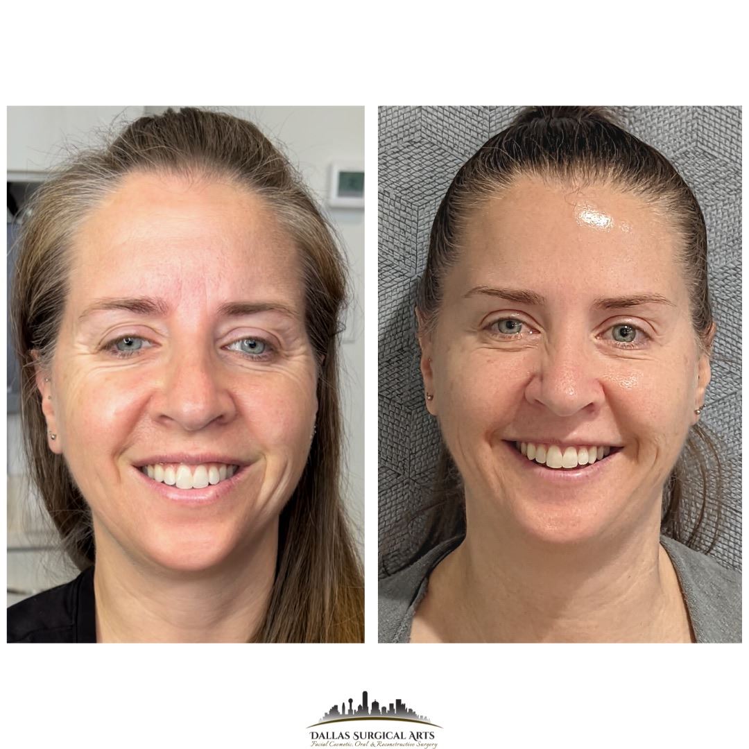 Cheek Filler | Dallas Oral Surgery
