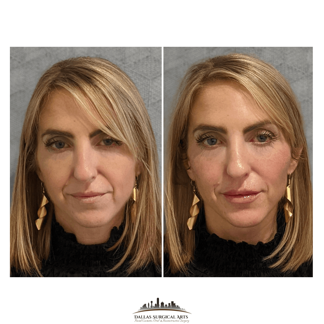 Cheek Filler | Dallas Oral Surgery