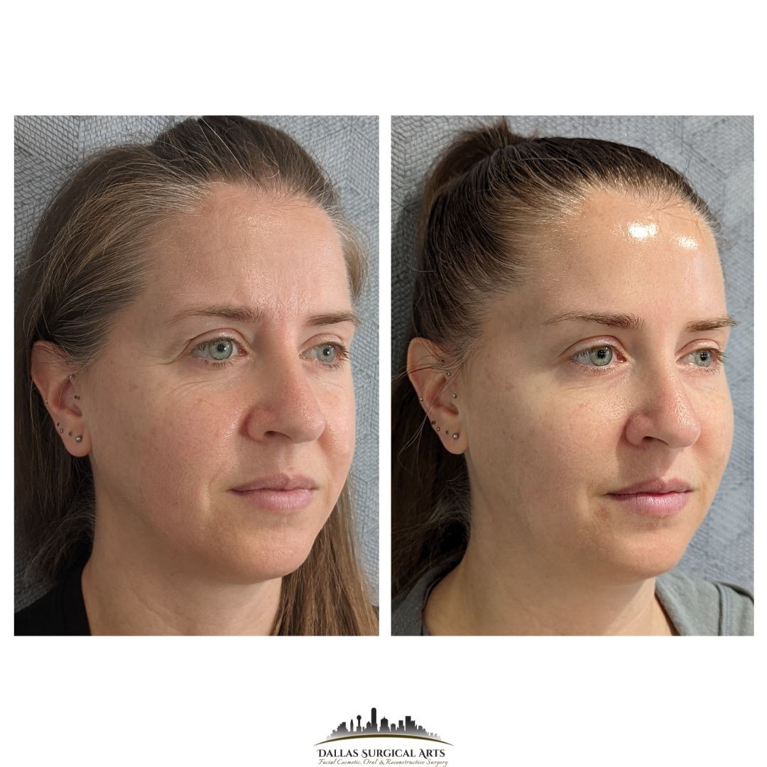 Cheek Filler | Dallas Oral Surgery