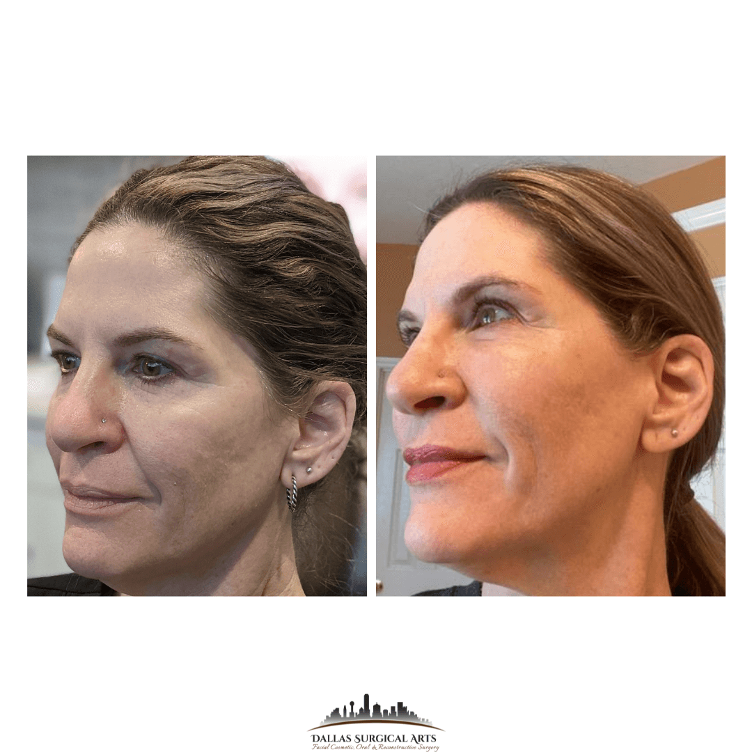 Cheek Filler | Dallas Oral Surgery