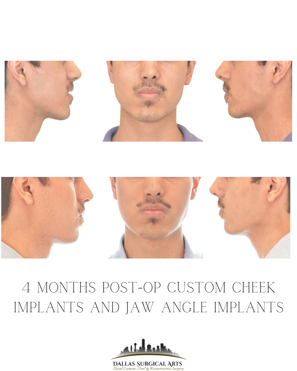 Cheek Implant | Dallas Oral Surgery