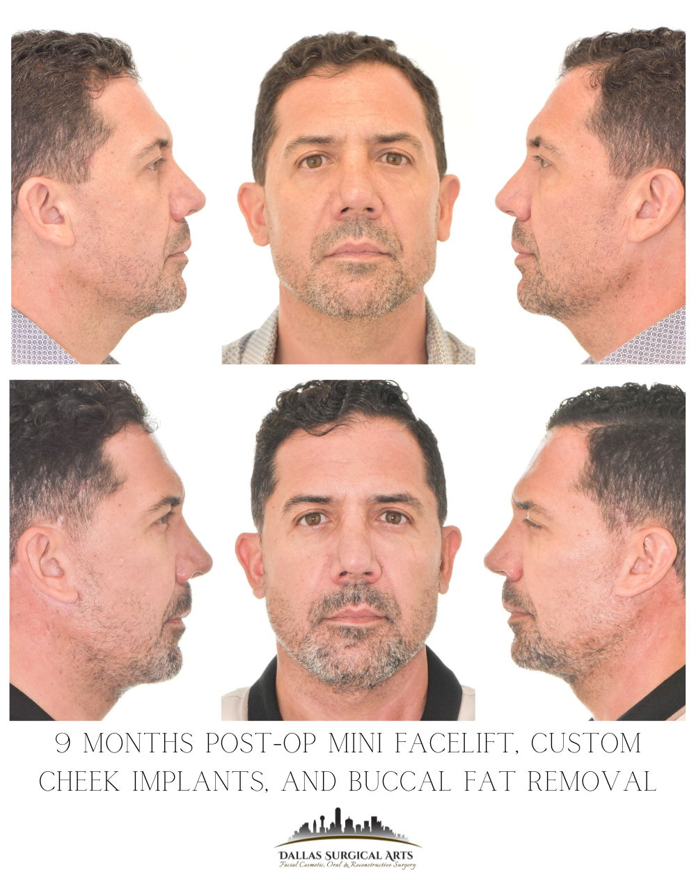 Cheek Implant | Dallas Oral Surgery