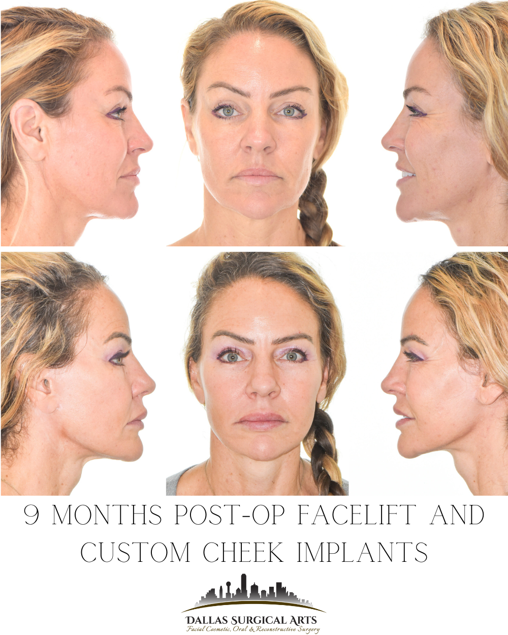 Cheek Implant | Dallas Oral Surgery