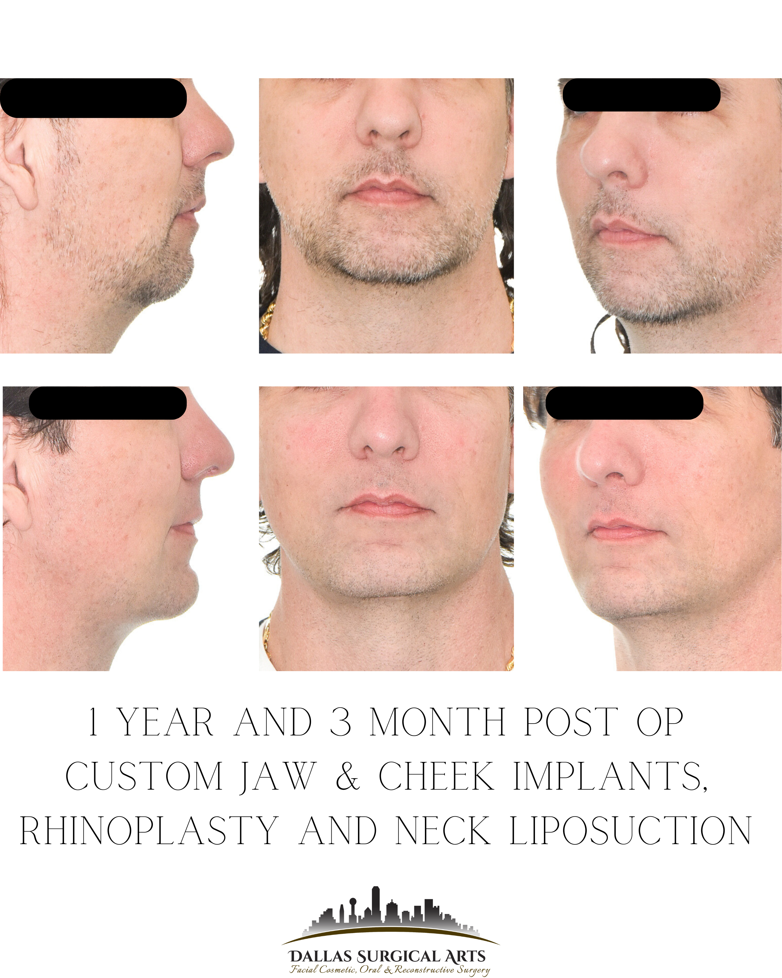 Cheek Implant | Dallas Oral Surgery