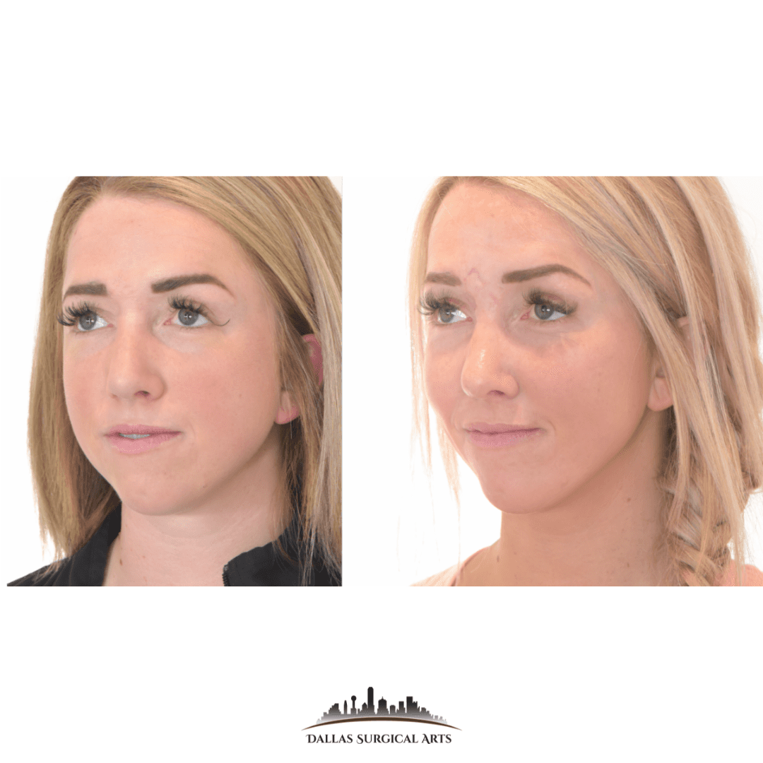 Cheek Implant | Dallas Oral Surgery