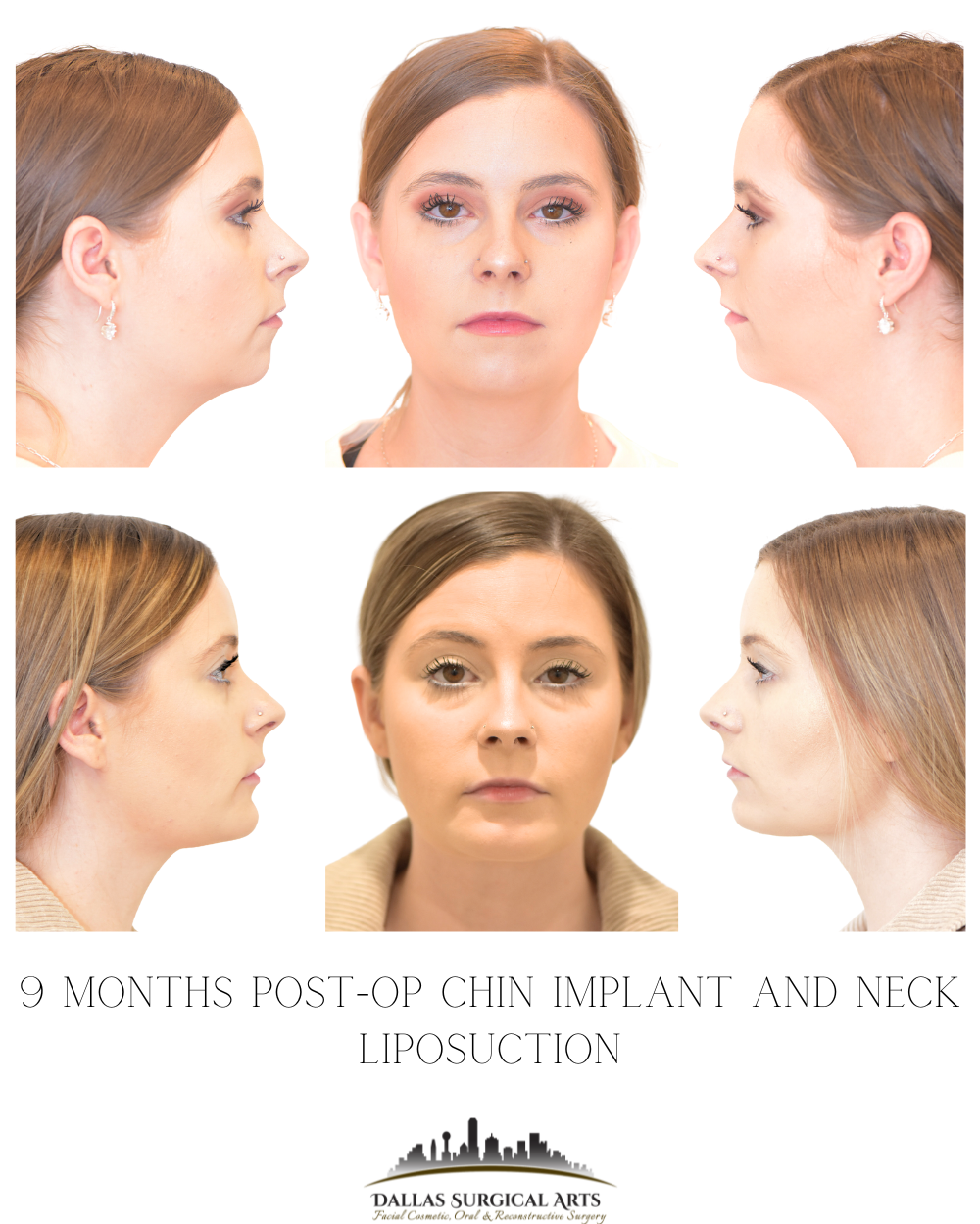 Chin Implant | Dallas Oral Surgery