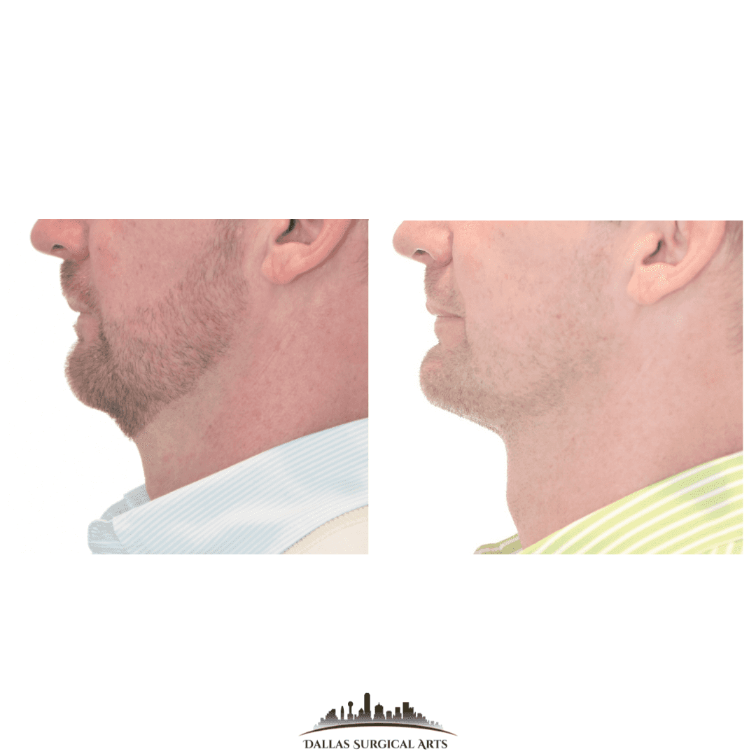 Chin Implant | Dallas Surgical Arts