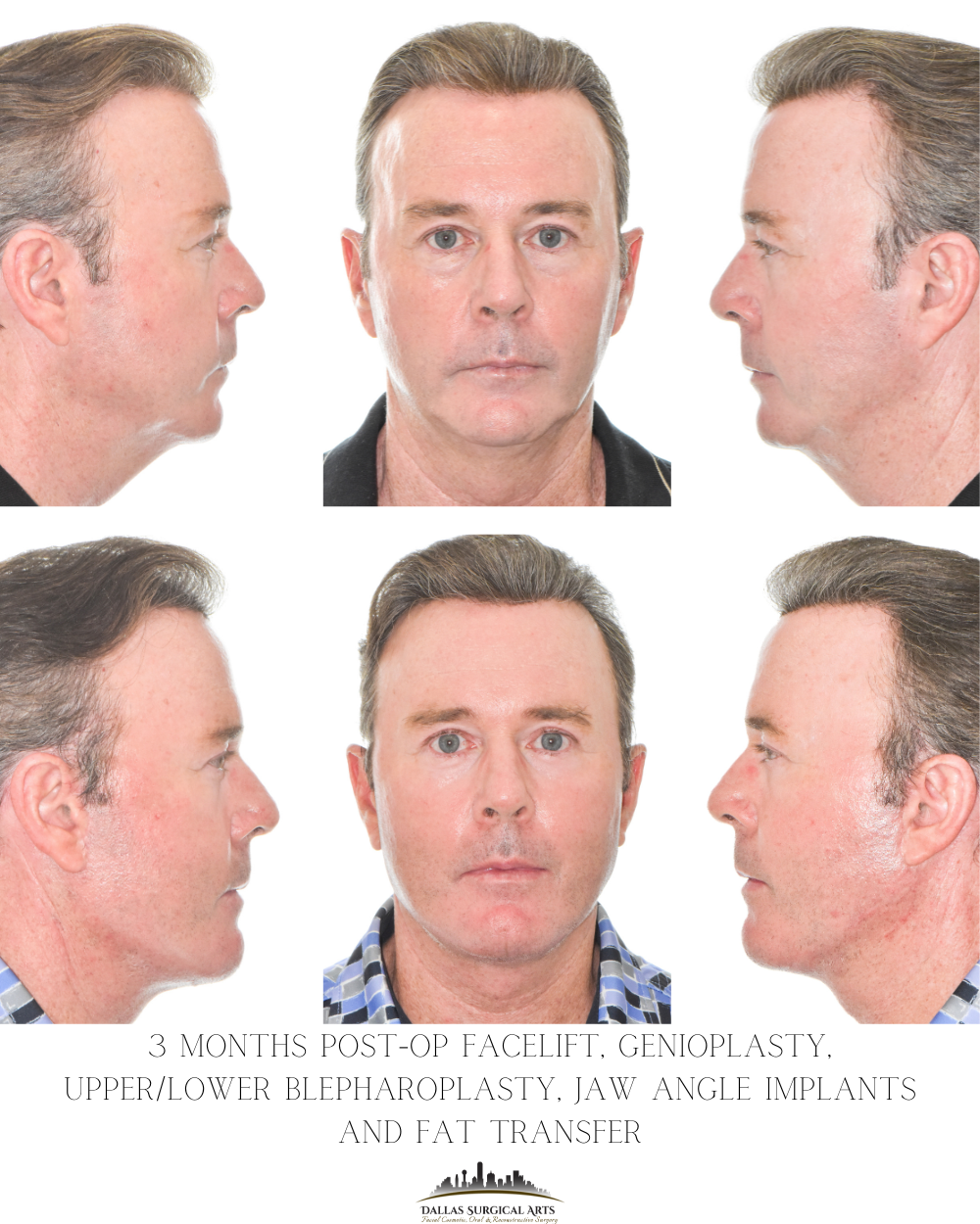 Different Types of Face Lifts - Dallas Facelift Surgeon Dr. Randy Sanovich