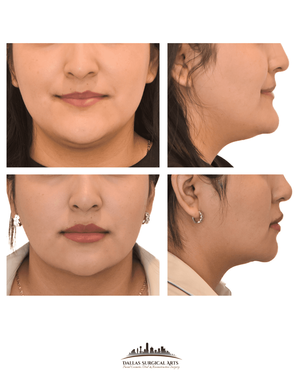 Long Chin Reduction Surgery in Dallas