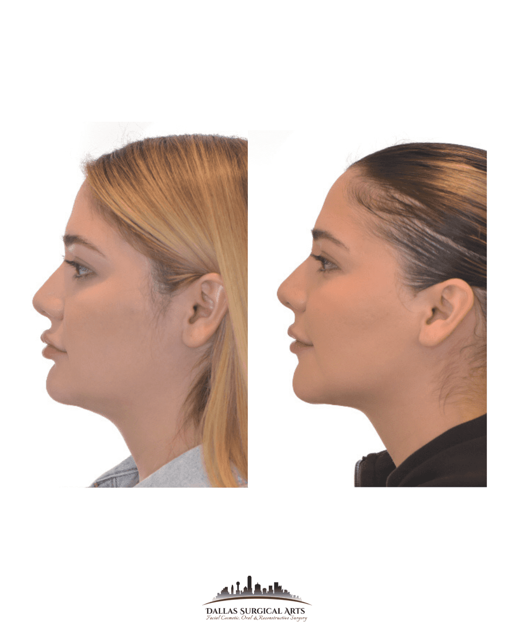 Genioplasty | Dallas Oral Surgery