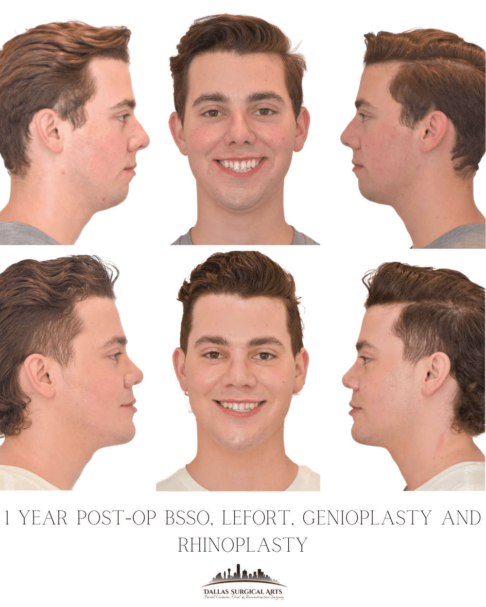 Recovery After Chin Surgery: What to Expect from Your Jawline Surgery