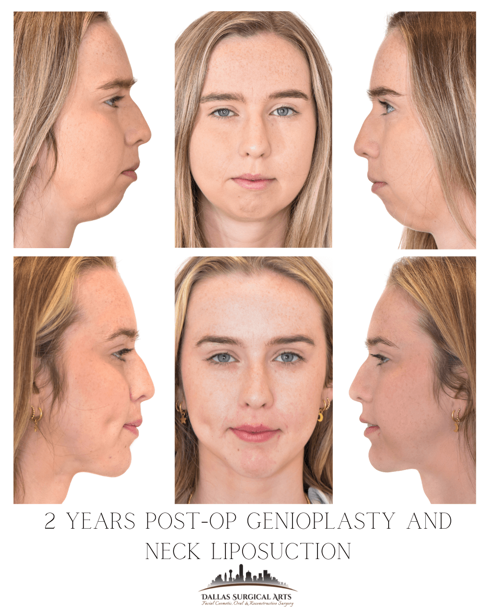 Genioplasty | Oral Surgery in Dallas