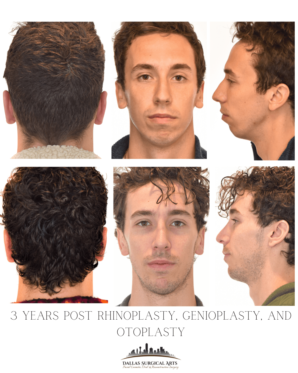 Genioplasty | Oral Surgery in Dallas