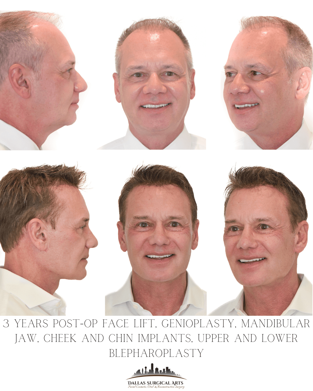 Genioplasty | Oral Surgery in Dallas
