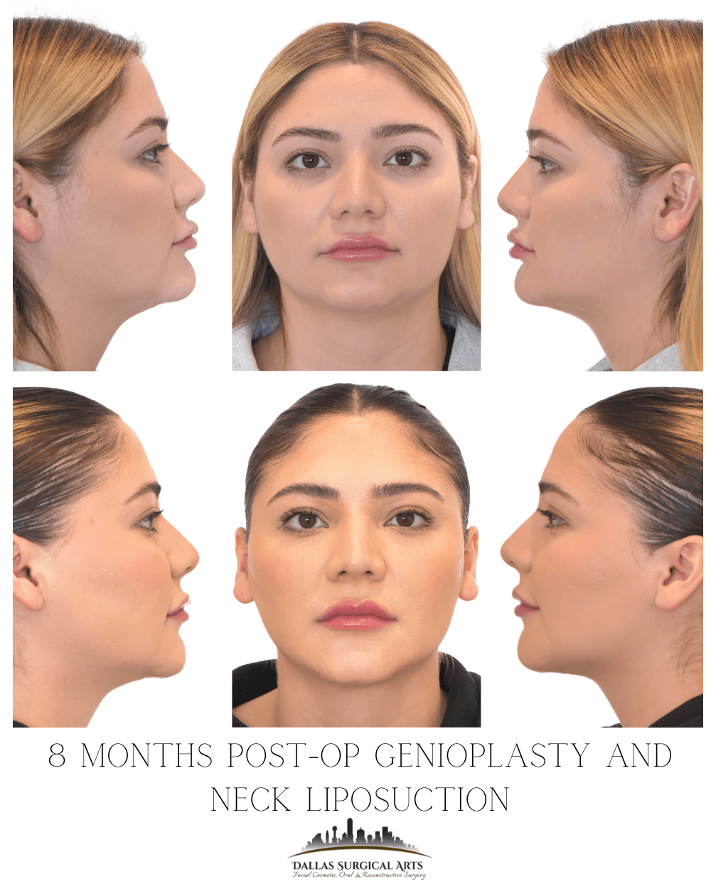 Genioplasty | Oral Surgery in Dallas